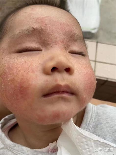 宝宝湿疹反反复复，终于好了 知乎
