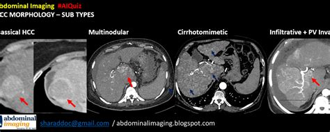 Hcc Part 6 Hepatocarcinogenesis Hcc Progressed