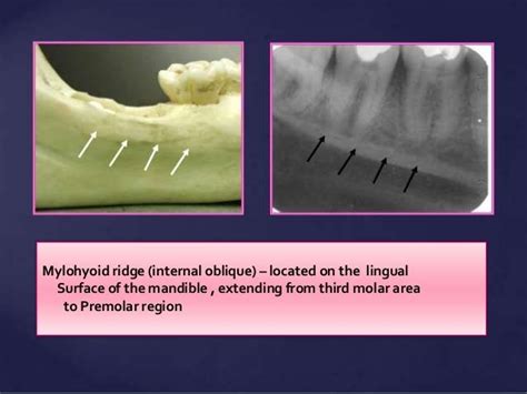 Internal Oblique Ridge Radiograph