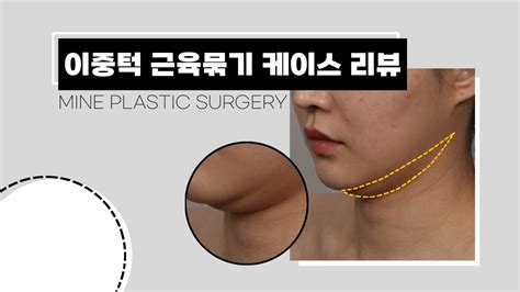 윤곽주사로도 해결 못한 이중턱 확실한 해결방법은 ｜ 이중턱근육묶기 케이스 리뷰 Youtube