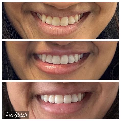 Masseter Gone Wrong R Botoxsupportcommunity