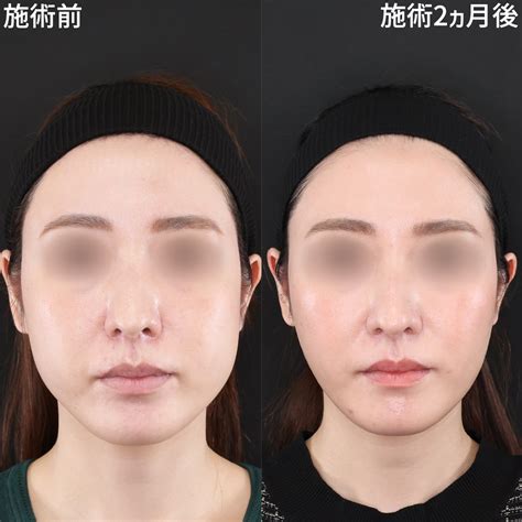 下膨れ感を解消し 笑顔もすっきり小顔に！｜症例写真・ビフォーアフター｜美容整形･美容外科のtaクリニックグループ