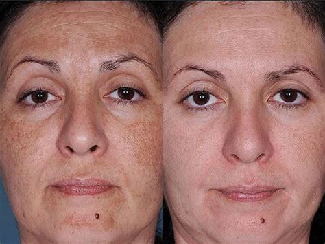 Кислотный пилинг для лица поверхностный срединный глубокий химический пилинг фото до и после