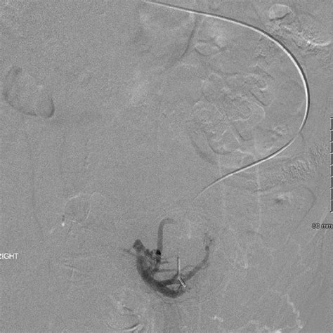 Digital Subtraction Venography Showing Stomal Varices Arising From The Download Scientific