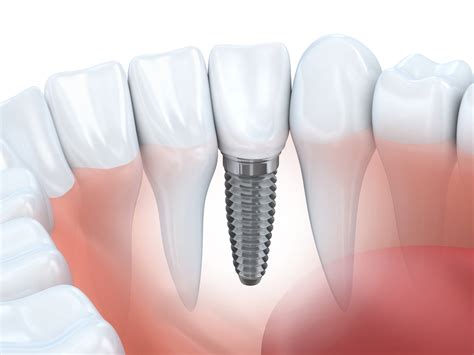 Causas de rechazo de los implantes dentales Clínica Larrañaga