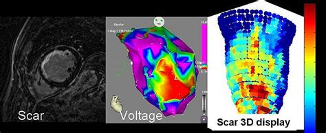 2010 summer project week left ventricular scar segmentation namic wiki