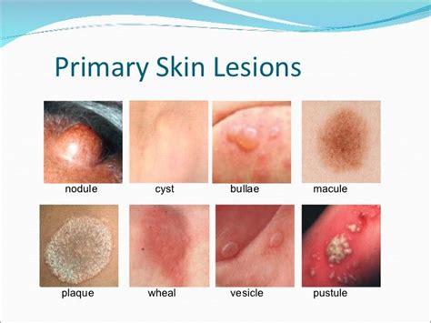 Skin Lesions Skin Dermatology Nurse Respiratory Care
