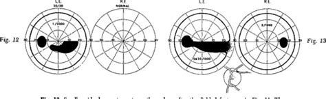 Figure 2 From Differential Diagnosis Of The Arcuate Scotoma Semantic Scholar
