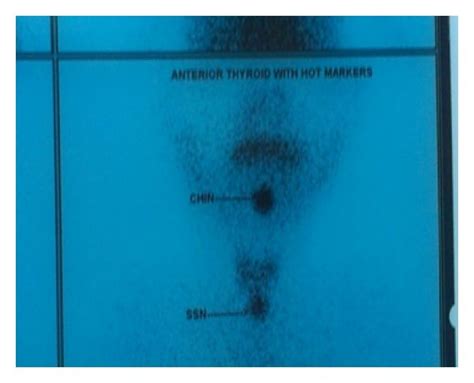99 M Technetium Pertechnetate Scan No Abnormal Tracer Uptake Was Seen