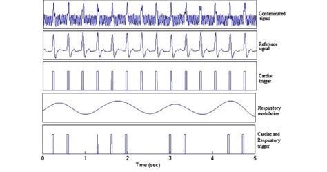 Synchronization Signal Extraction Cardiac Respiratory Trigger