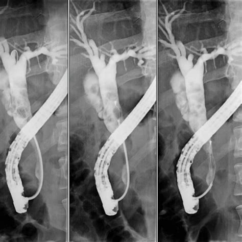Eus Rendezvous Ercp In A Patient With Failed Common Bile Duct Cbd