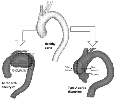 Double Aortic Arch Repair