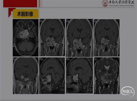 刘庆教授：内镜下经翼突入路复杂三叉神经鞘瘤切除术 脑医汇
