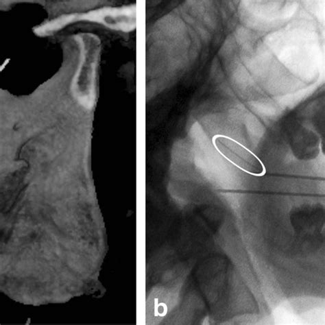 A Patient 1 With Three Dimensional Cbct Reconstruction With Needle