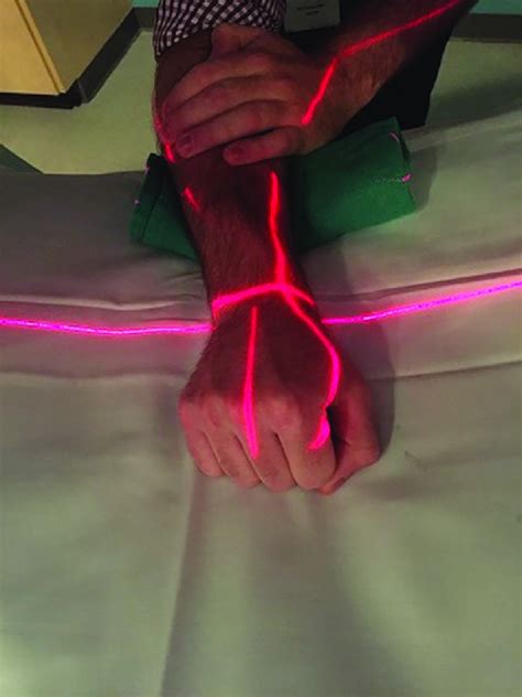 Participant Wrist Positioning In The Ct Scanned Download Scientific
