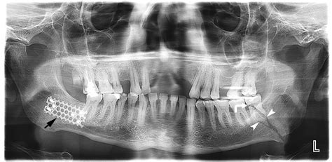 Mandibular Fracture X Ray