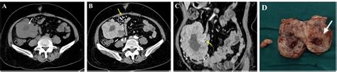 A 56 Year Old Woman With A Small Intestinal Gastrointestinal Stromal