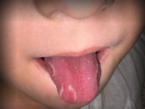 Dr Abdullah On Linkedin ⚫ Geographic Tongue Also Known As Benign