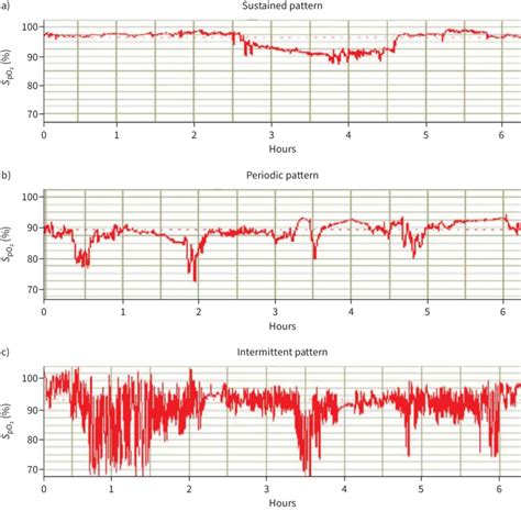 Pulse Oximetry In Obstructive Sleep Apnea At Crystal Molden Blog