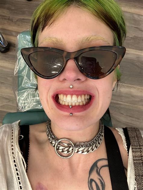 Got My Braces Off After Almost 3 Years Rbraces