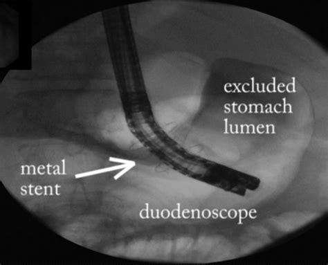 Internal Eus Directed Transgastric Ercp Edge Game Over