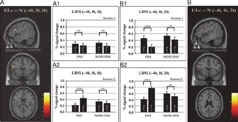 Brain Activation And Roi Analysis For The Pars Triangularis Of The Left