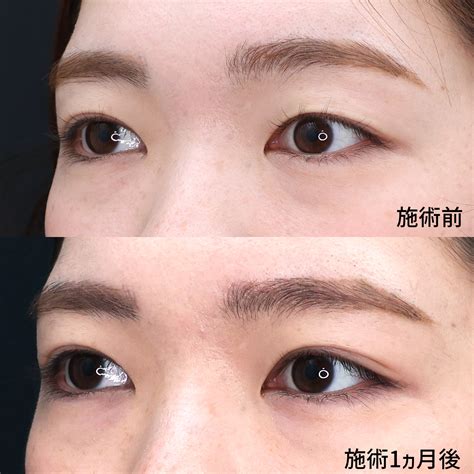 【片目二重術】自然で左右共に整った末広型二重ラインへ。｜症例写真・ビフォーアフター｜美容整形･美容外科のtaクリニックグループ