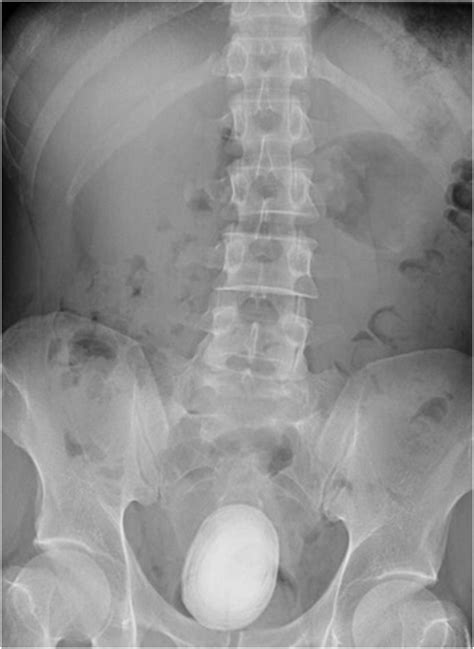 X Ray Kub Showing A Large Calculus In The Bladder Download