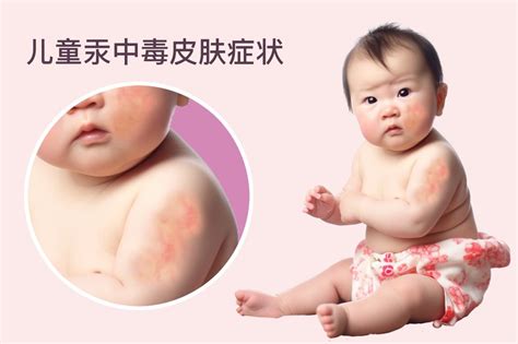 儿童汞中毒皮肤症状图片医疗图片素材高清图片素材