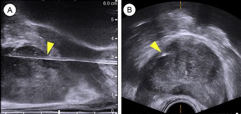 Cpt Code For Transperineal Prostate Biopsy
