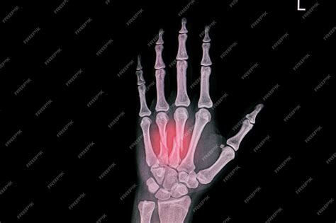 Right Hand X Ray