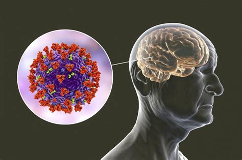 Slobodna Dalmacija Dugotrajni Covid značajno utječe na mozak ljudi s