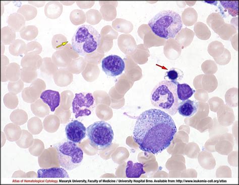 Myelodysplasticmyeloproliferative Neoplasm With Ring Sideroblasts And Thrombocytosis Mdsmpn