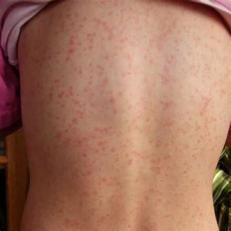 Strep Throat Rash Face