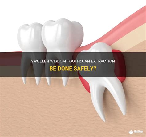 Swollen Wisdom Tooth Can Extraction Be Done Safely Medshun