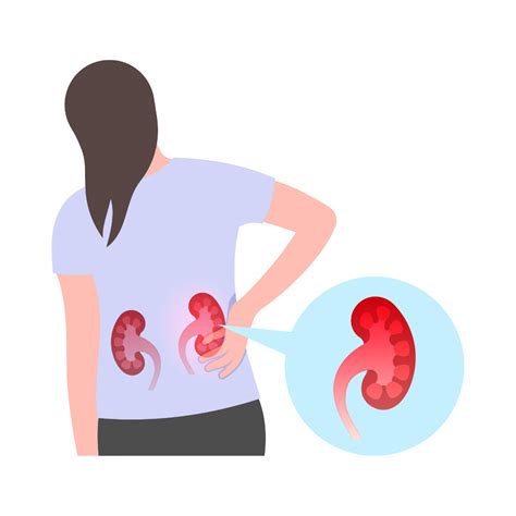 Urolithiasis Body Support Natural Supplements And Prevention