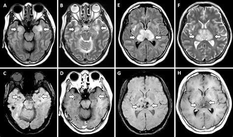 Acute Necrotizing Encephalopathy Associated With Hemophagocytic My