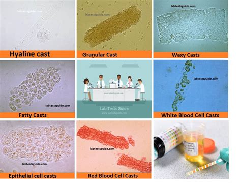 Urinery Casts Types Results And Clinical Significations Lab Tests Guide It Cast Test Guide