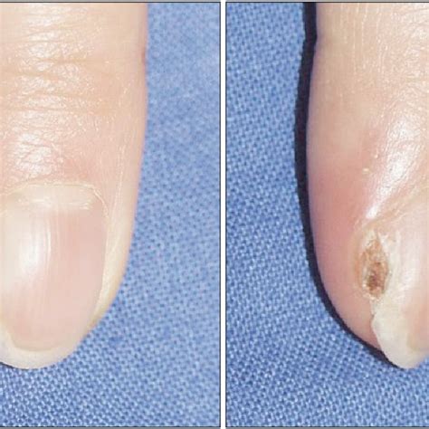 A Poorly Circumscribed Dermal Tumor With Myxoid And Fibrous Areas