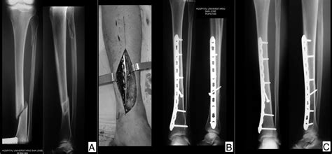 Stable Fracture Tibia Fracture Tibiale Fermée Oqfhvi