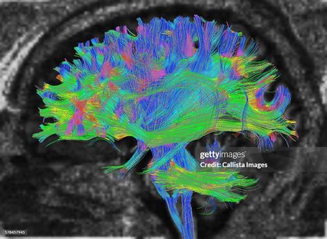 Diffusion Mri Also Referred To As Diffusion Tensor Imaging Or Dti Of