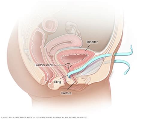 Retropubic Sling Mayo Clinic