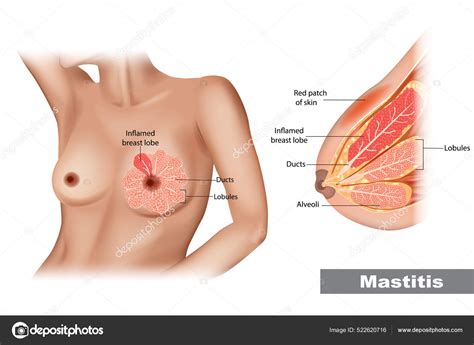 Mastite Secção Transversal Da Glândula Mamária Com Inflamação Leite