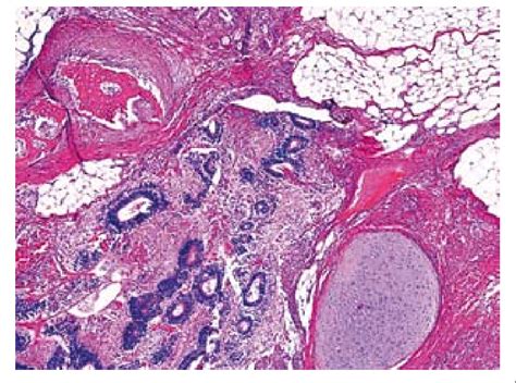 Rare Foci Of Neuroectodermal Rosettes In The Immature Ovarian Teratoma
