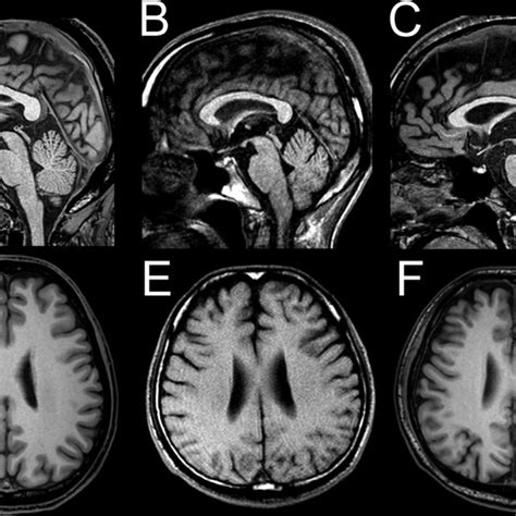 Brain Sagittal And Axial Magnetization Prepared Rapid Gradient Echo