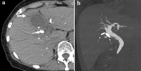 Drip Infusion Cholangiography Ct An Unopacified Dilated Bile Duct Download Scientific Diagram
