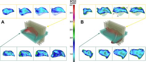 Maximum Principal Stretch Map Of The Cardiac Lobe Axial Transverse And