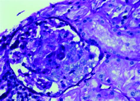 Glomerulus With Cellular Crescent And Fibrin Necrosis Hallmark Of