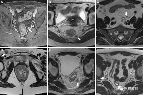 直肠癌MRI 影像PPT