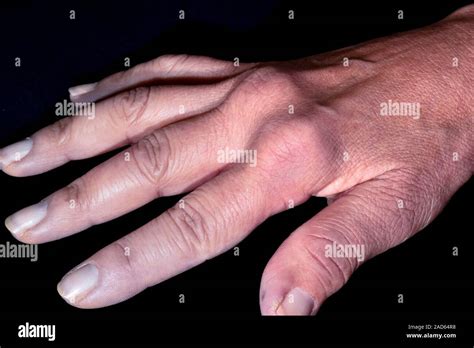 Hand In Crest Syndrome Close Up Of The Swollen Hand Of A 69 Year Old